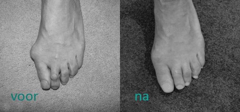 Hallux valgus - scheef staan van de grote teen. QUOLE for men orthopedie